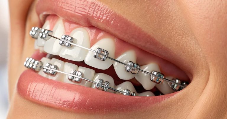 How Long Do Braces Stay On? Treatment Timeline